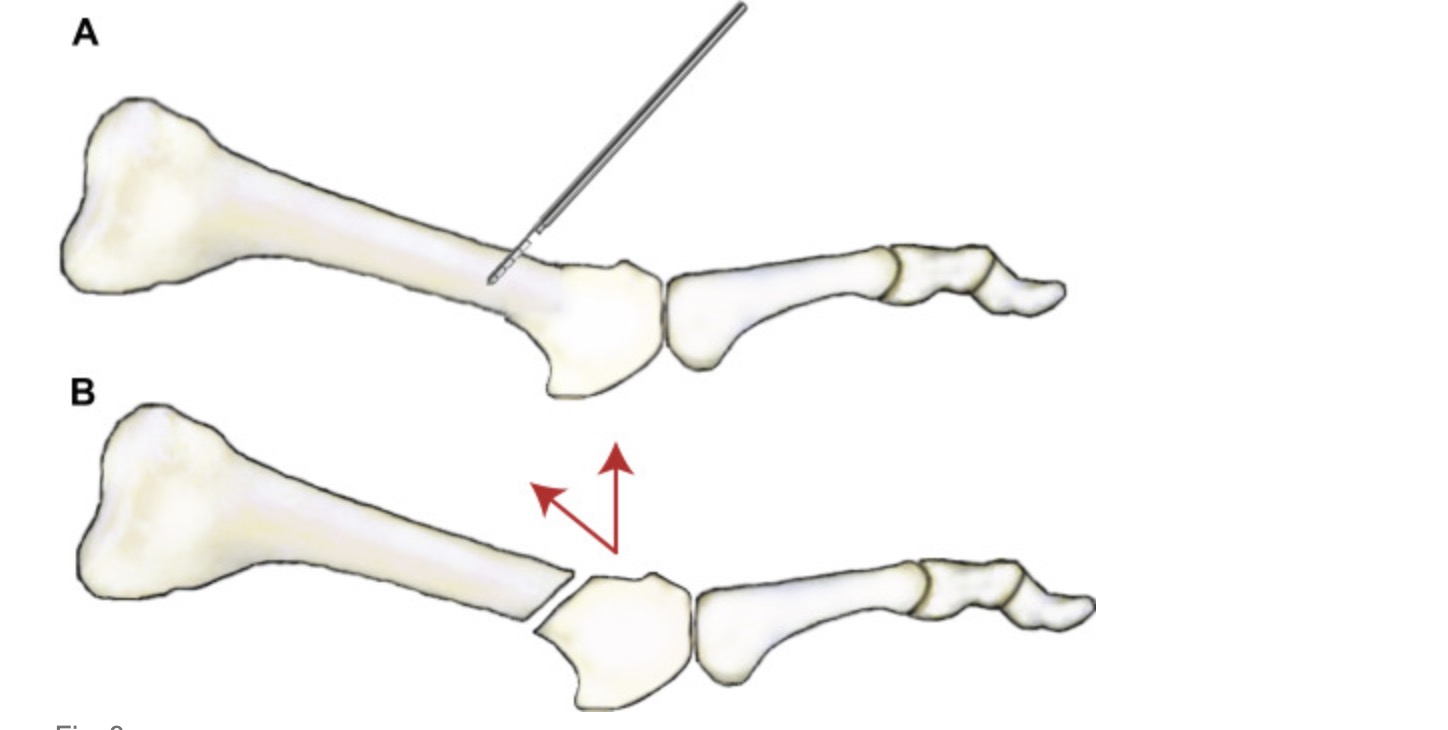 Minimally Invasive Distal Metatarsal Diaphyseal Osteotomies (DMDO) in ...