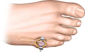 Meta-analysis of the outcomes of metatarsal head resection for the ...