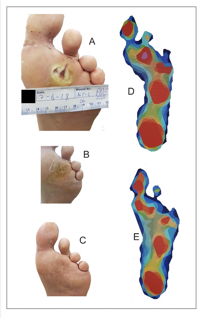 Effect of Mini-invasive Floating Metatarsal Osteotomy on Plantar ...