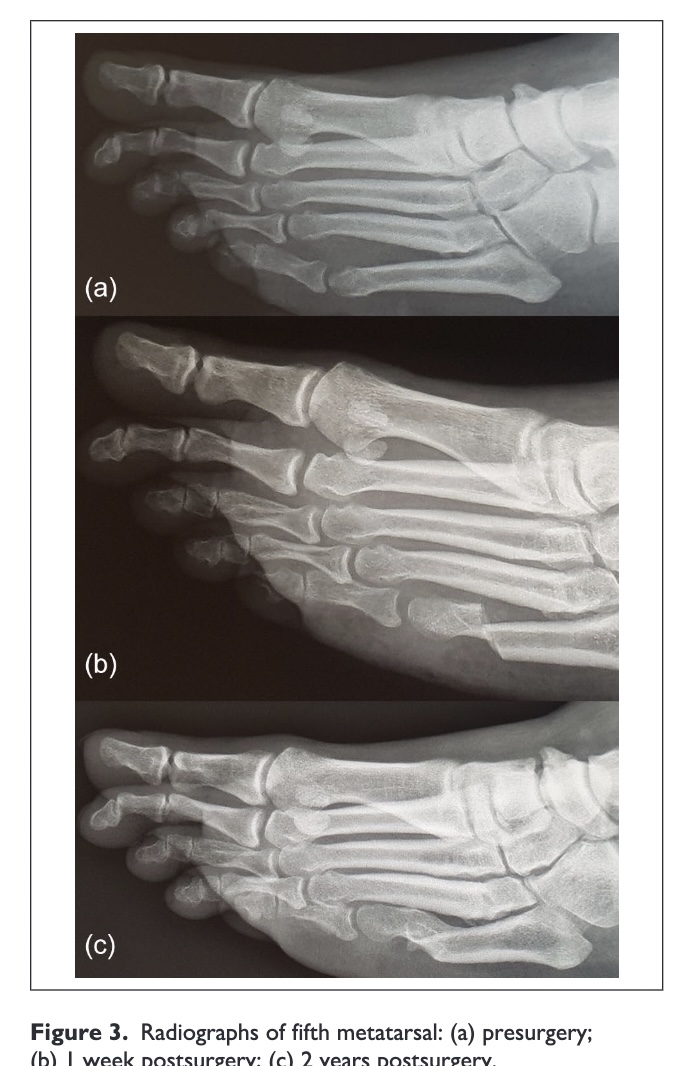 Effect of Mini-invasive Floating Metatarsal Osteotomy on Plantar ...
