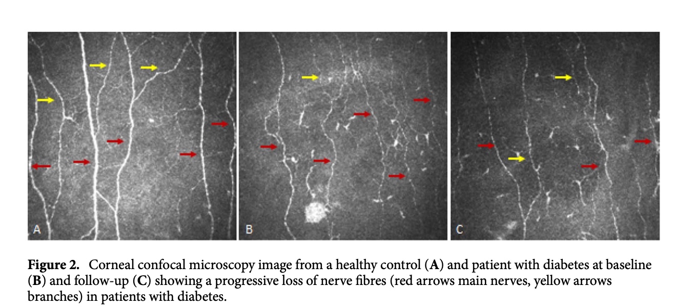 Corneal confocal microscopy identifies small fibre damage and ...