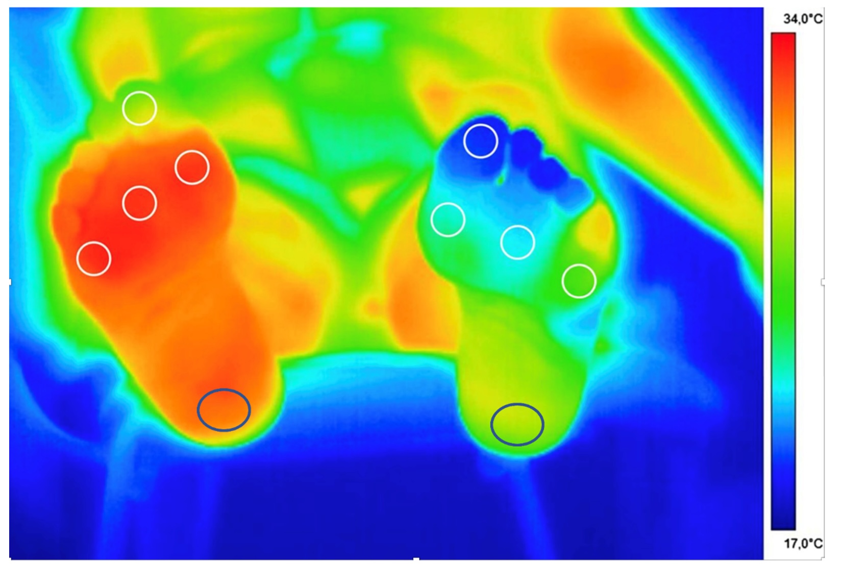 The Thermo-Pressure Concept: A New Model in Diabetic Foot Risk ...