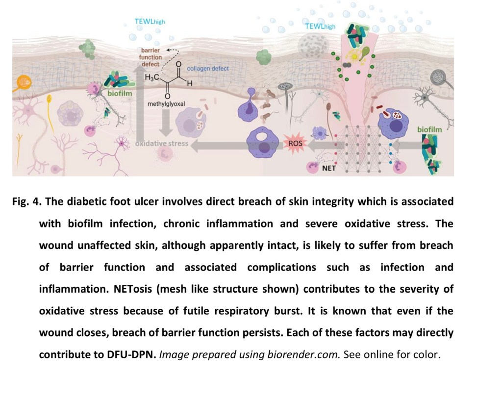 Diabetic Peripheral Neuropathy Associated with Foot Ulcer: One of a ...