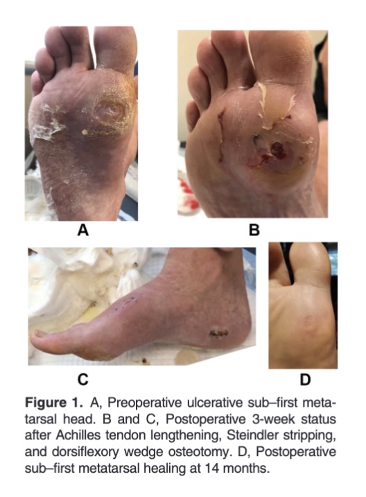 Surgical Treatment of Plantar First Metatarsal Ulcerations in High-Risk ...